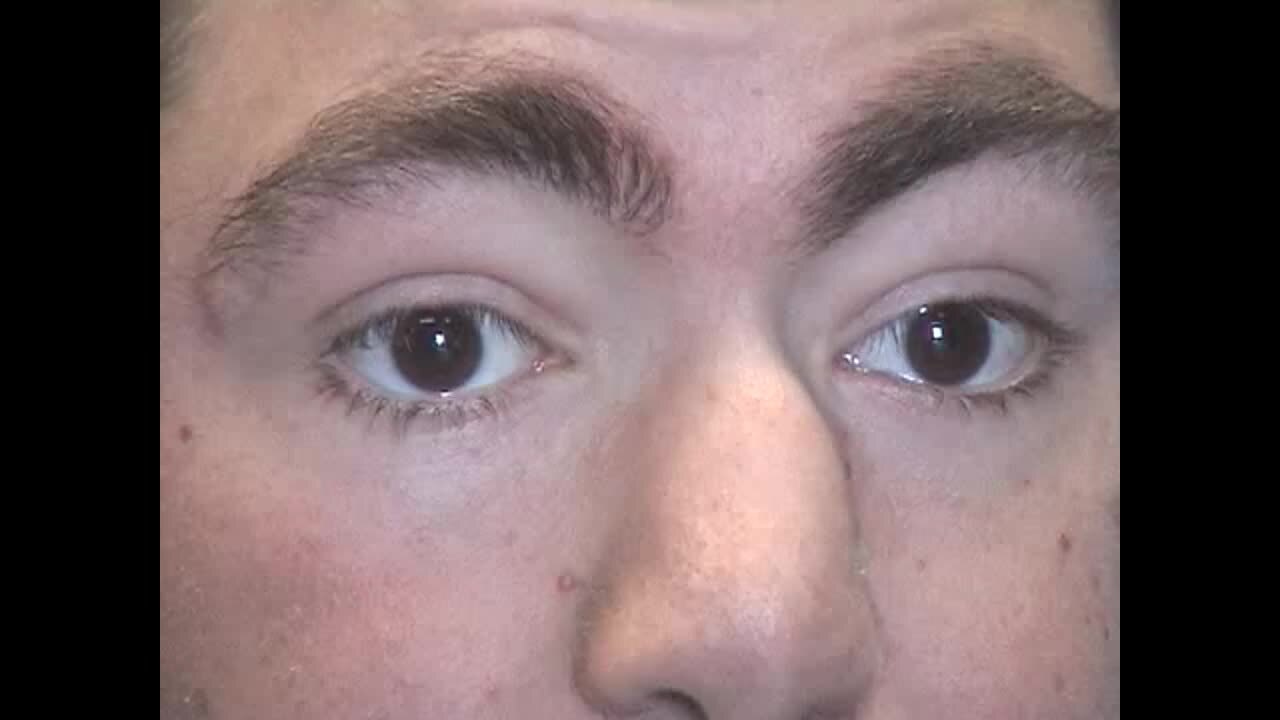 Jewish Eyelids