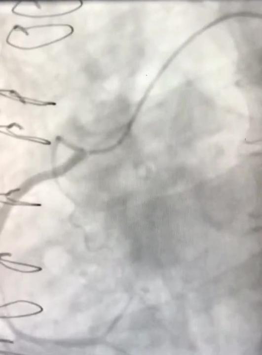 Ostial Stenosis Long Term Outcome Of Tandem Stenting For Stenoses Of