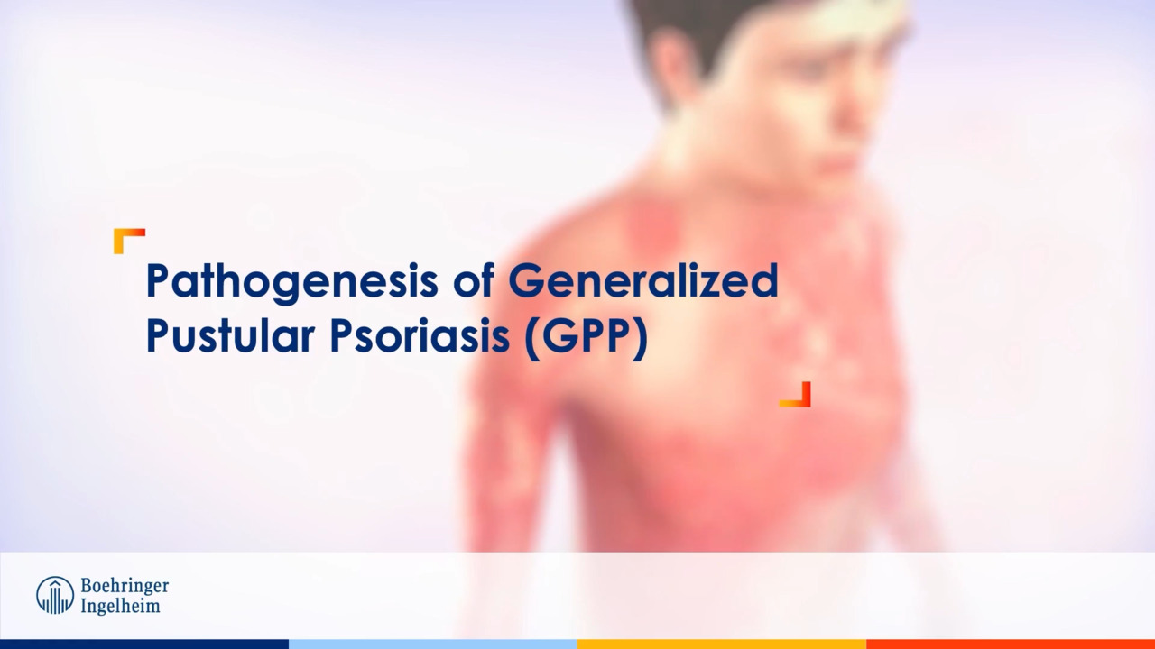 SEE HOW THE IL-36 PATHWAY WORKS AND LEARN ABOUT ITS ROLE IN THE PATHOGENESIS OF GPP | Boehringer ...